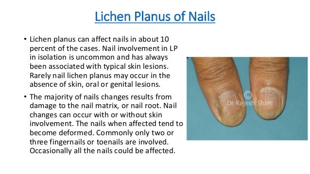 Lichen planus - complete knowledge
