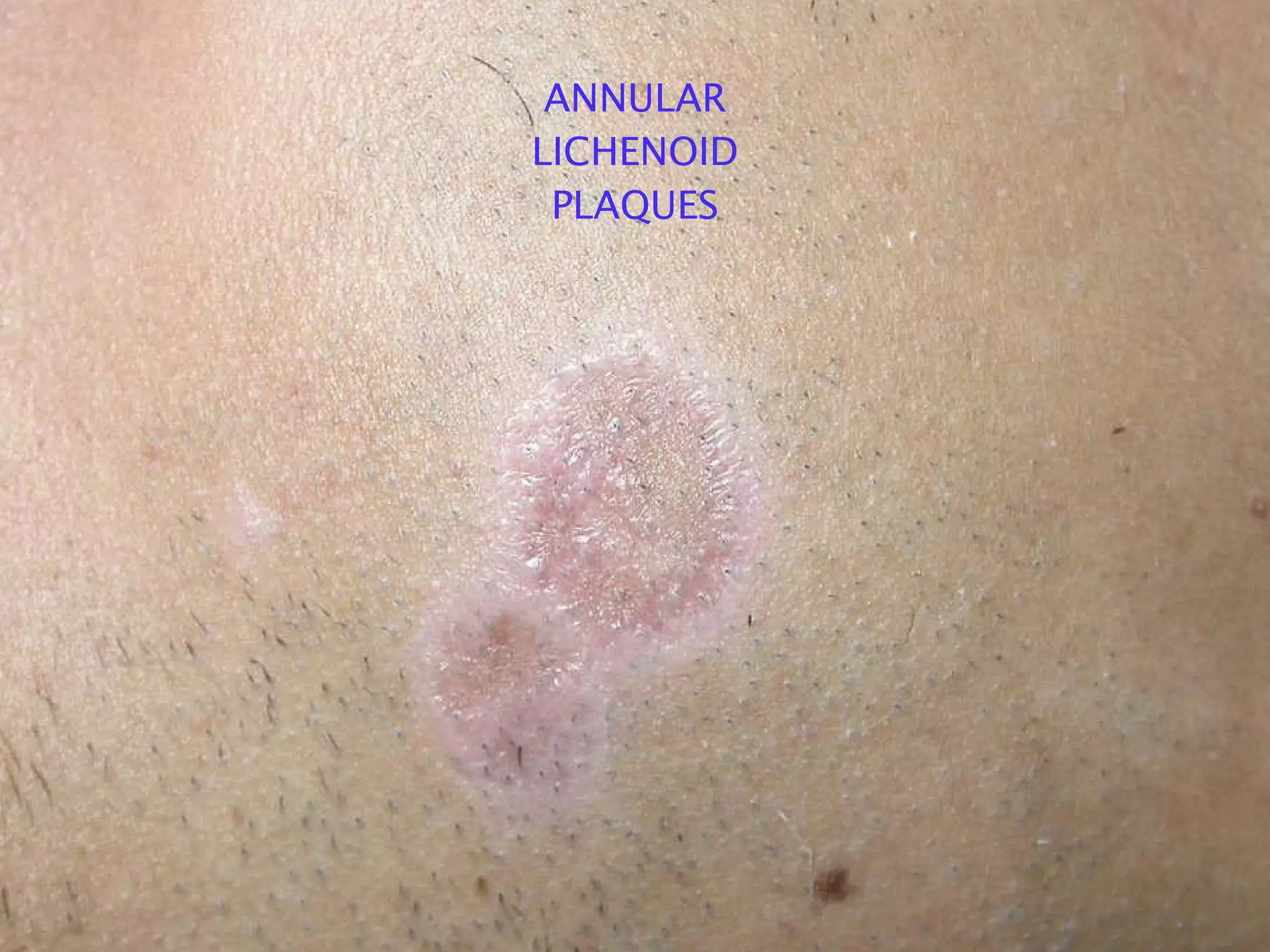 Actinic lichen planus | PPT