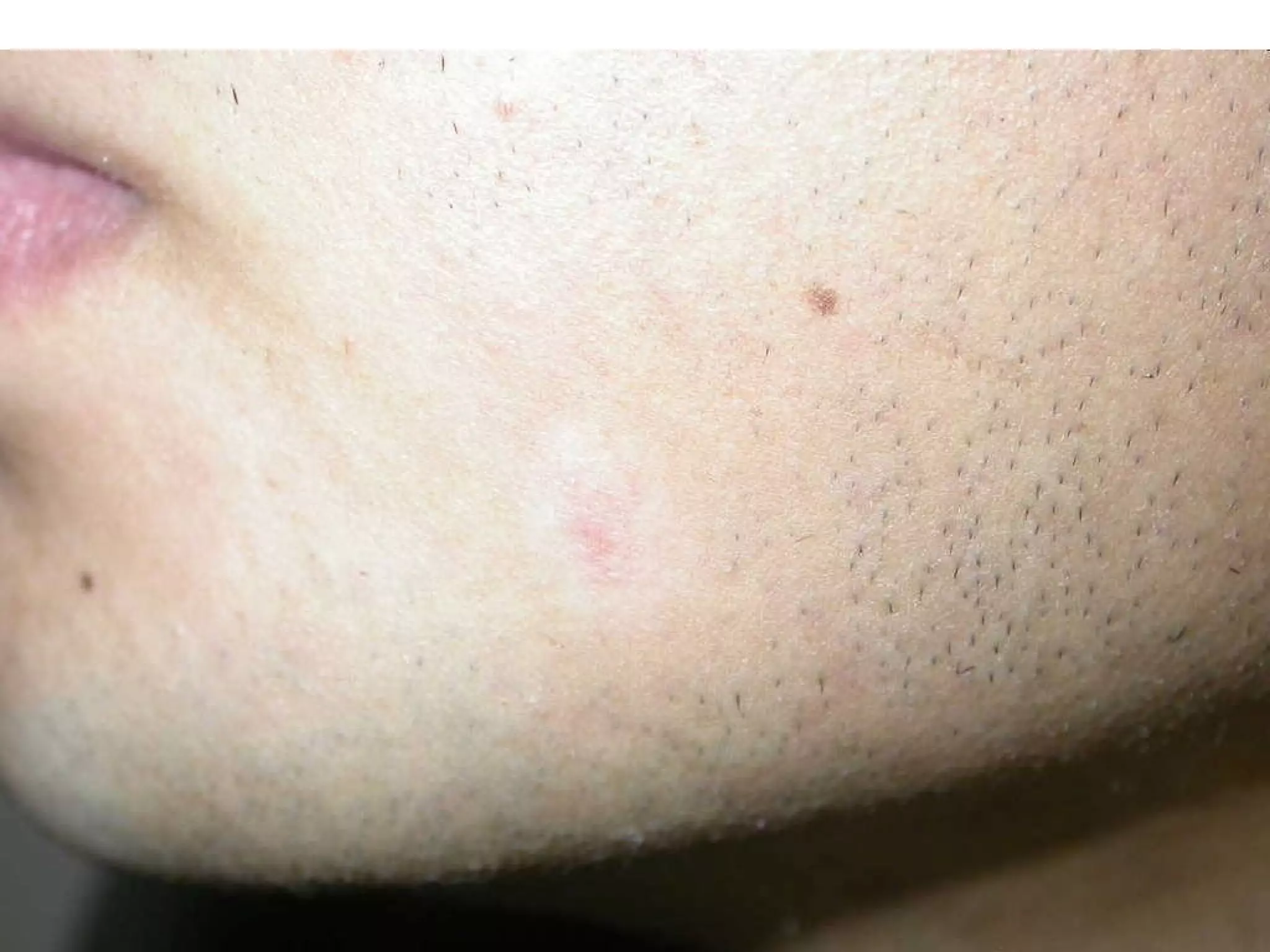 Actinic lichen planus | PPT