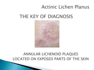 Actinic lichen planus | PPT