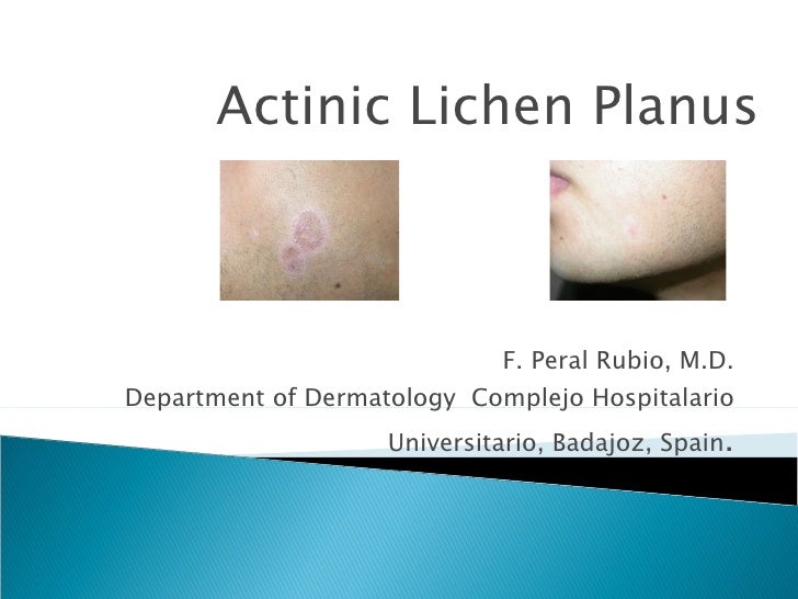 Actinic lichen planus