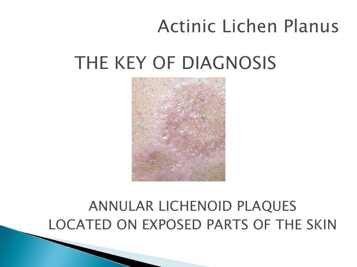 Actinic lichen planus