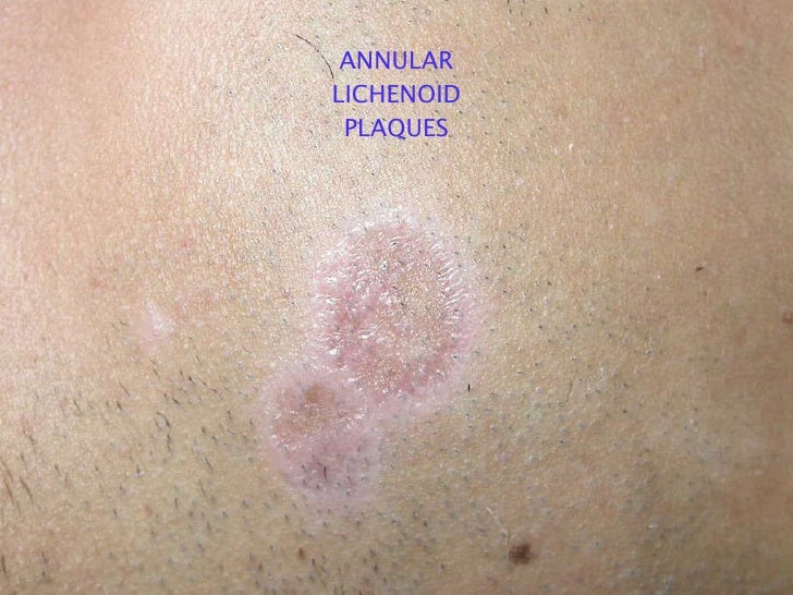Actinic lichen planus