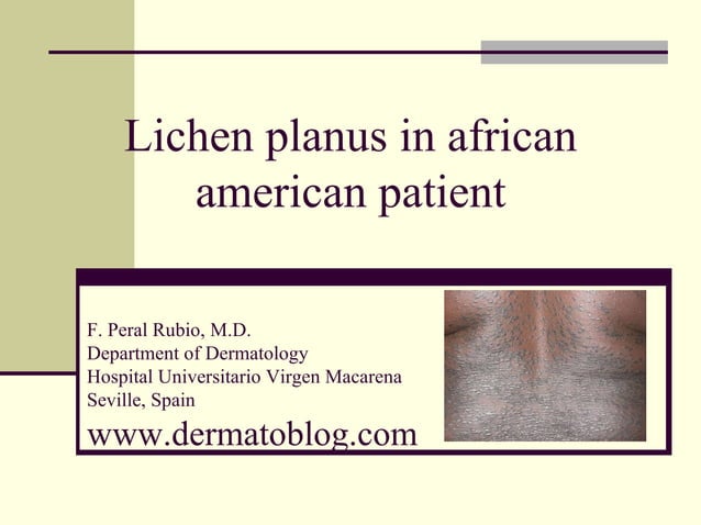 Lichen planus afroamerican people | PPT