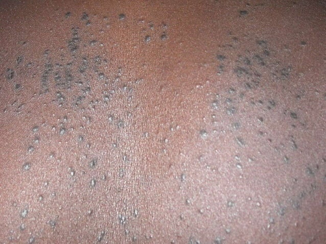 Lichen planus afroamerican people | PPT