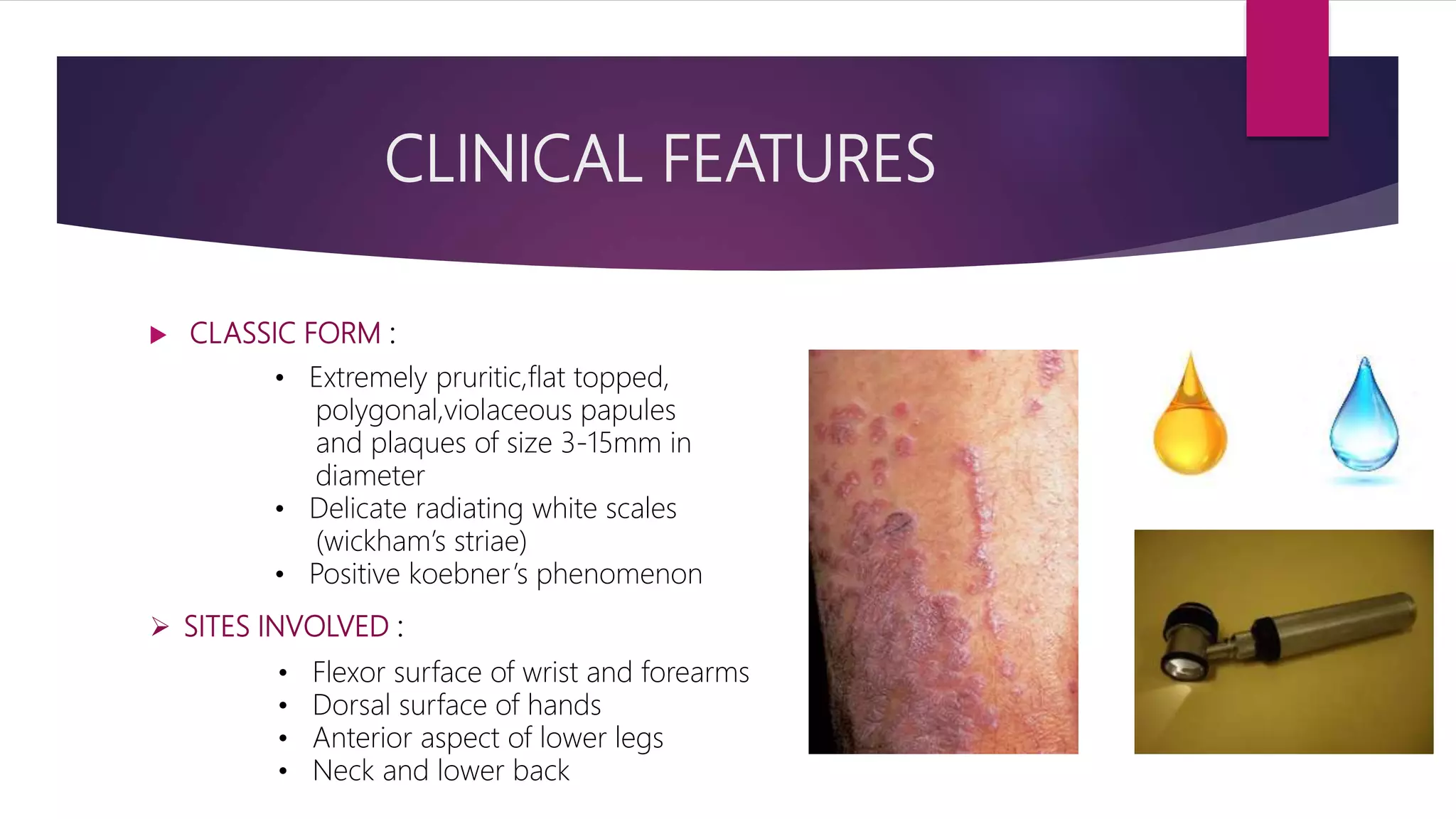 Lichen planus and lichenoid disorders | PPTX