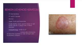 Lichenoid Keratosis
