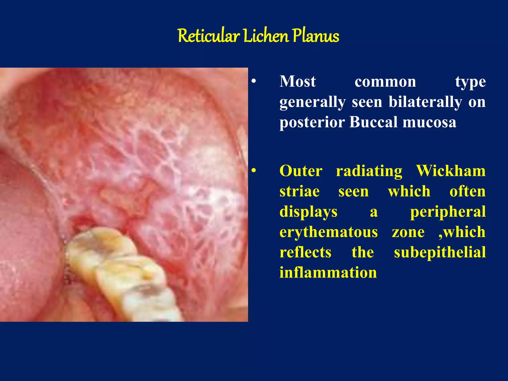 lichen planus and lichenoid reaction 4 .ppt | Skin and Dermatology ...