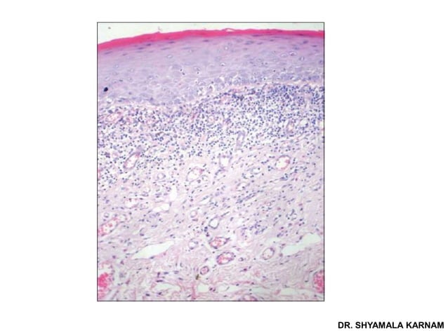 Lichen Planus | PPTX