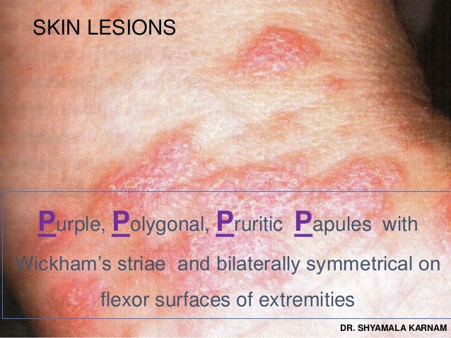 Lichen Planus