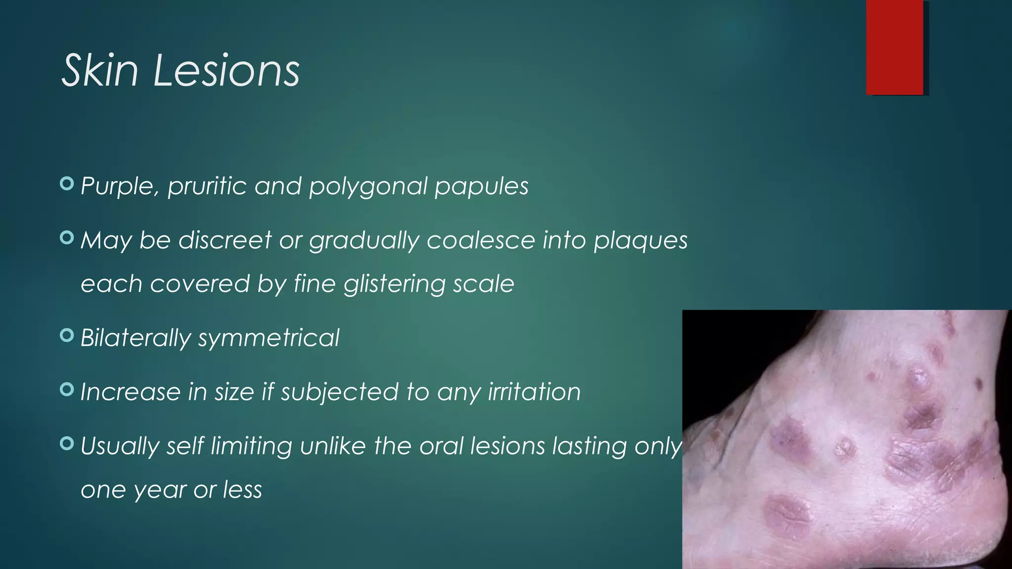 Oral Lichen Planus | PPT