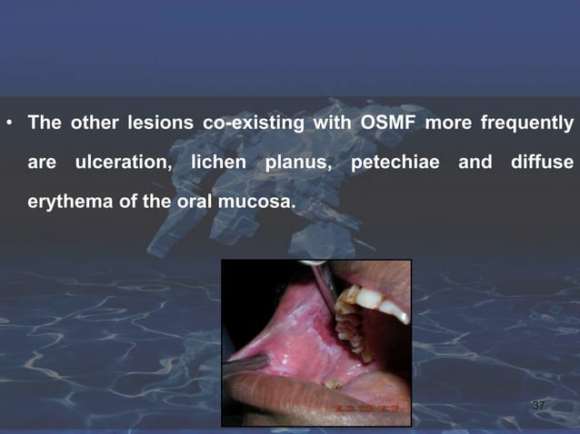 LICHEN PLANUS & OSMF | PPT