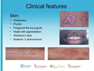 Lichen Planus part 1 | PPT | Skin and Dermatology | Diseases and Conditions