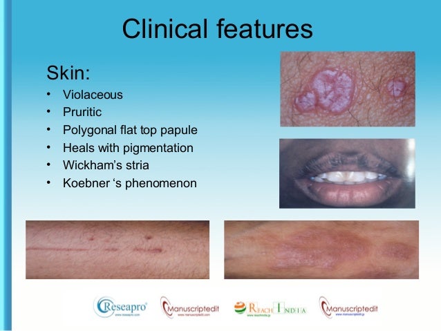 Lichen Planus part 1