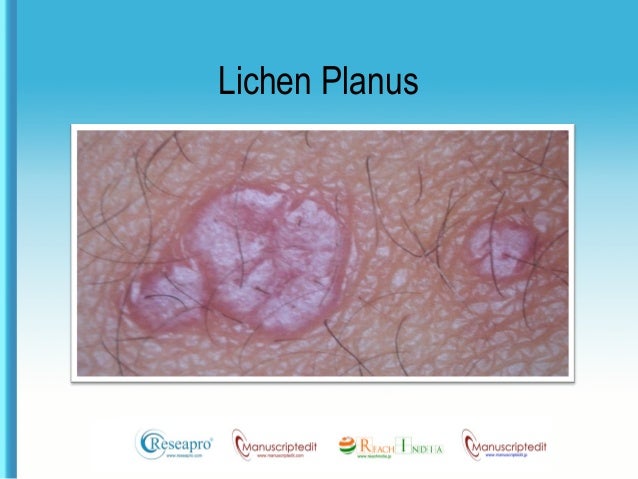 Lichen Planus part 1