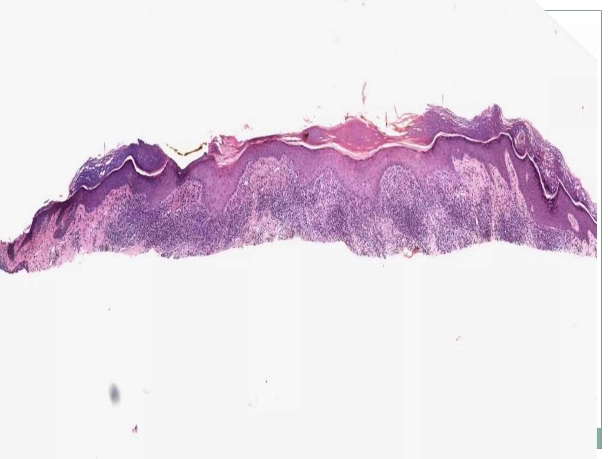 Lichen planus ppt | PPTX