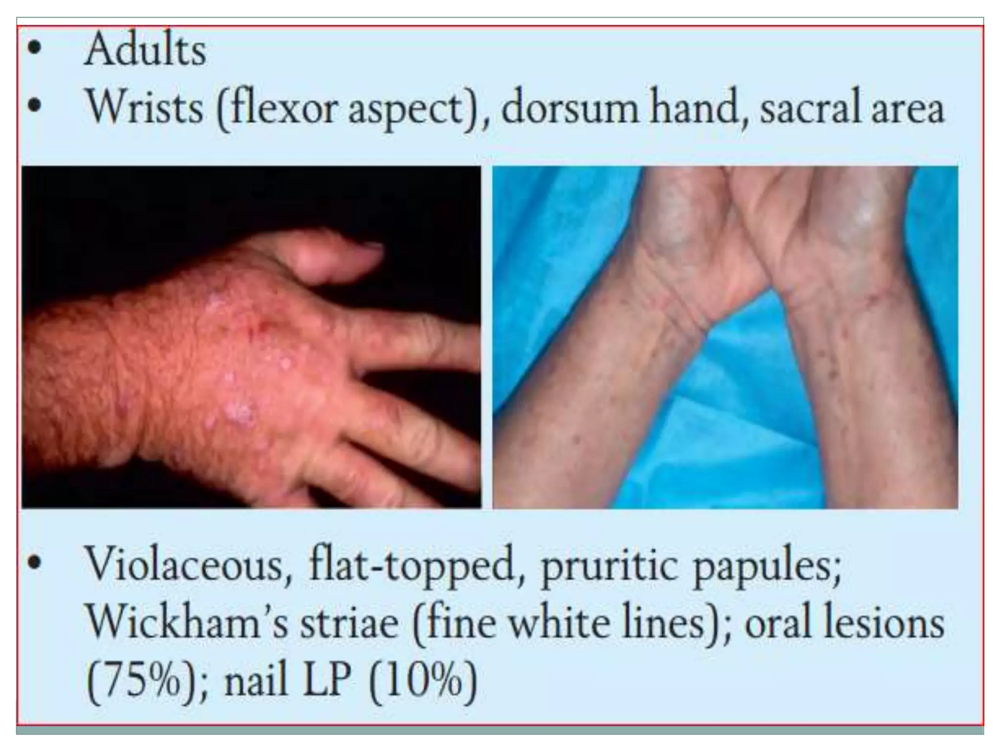 Lichen planus ppt | PPTX