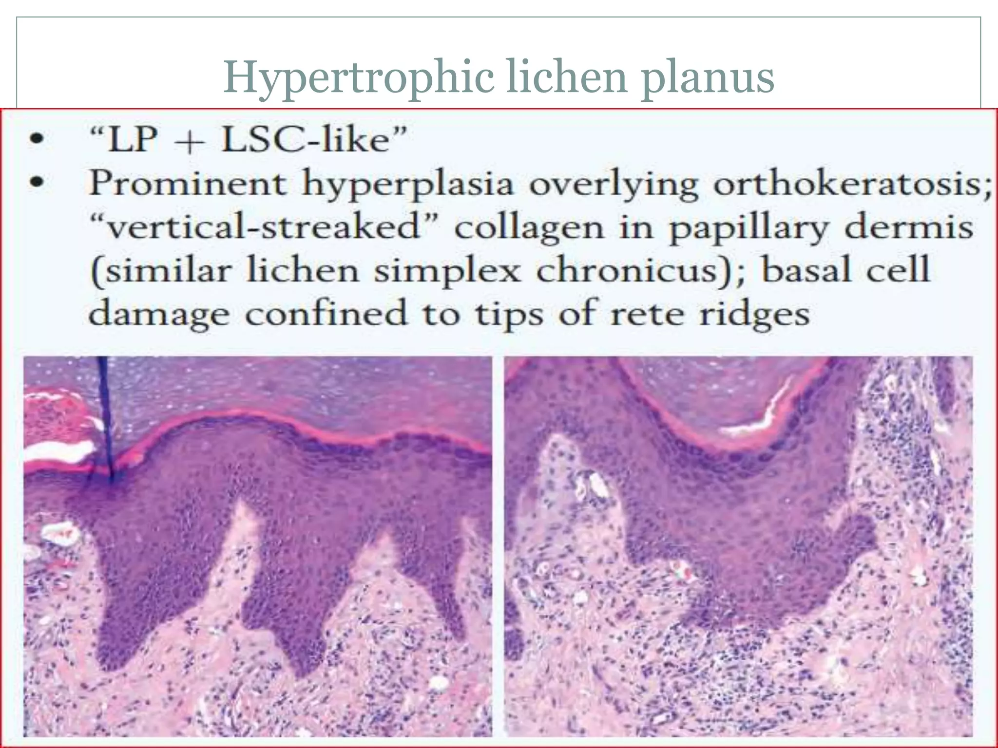 Lichen planus ppt | PPTX