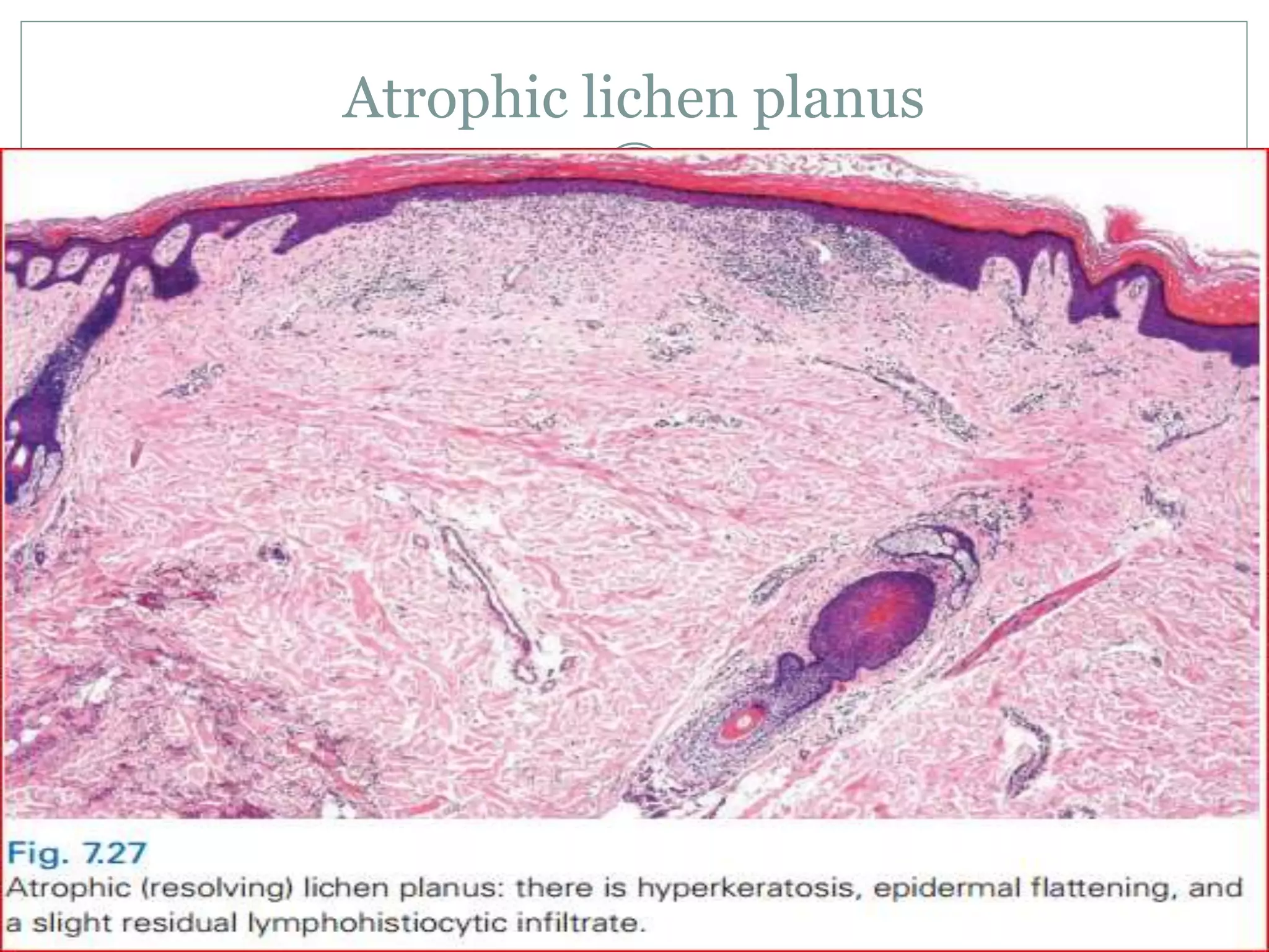 Lichen planus ppt | PPTX