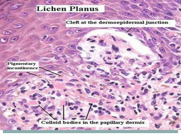 Lichen planus ppt | PPTX