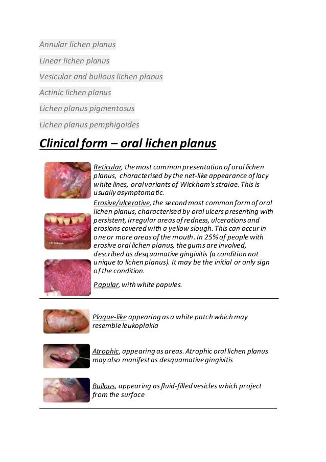 Linear Lichen Planus