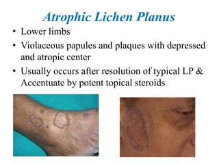 Lichen planus | PPT