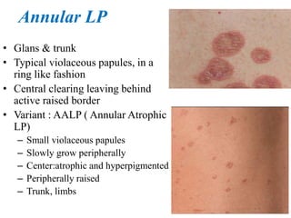 Atrophic Lichen Planus