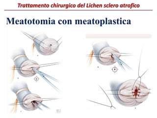 Lichen sclero atrofico | PPT