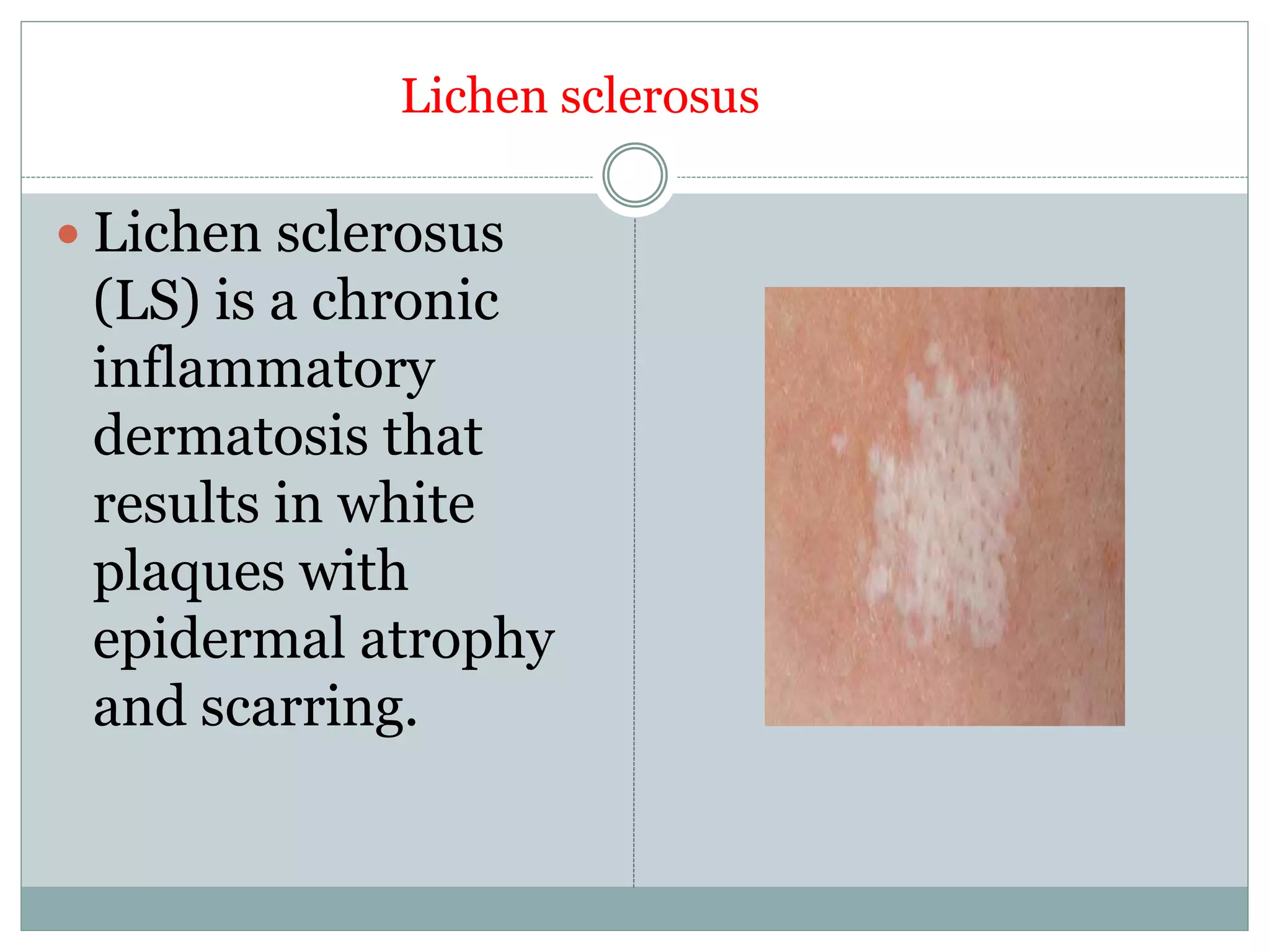 Lichen sclerosus by Saad Raheem Abed | PPTX