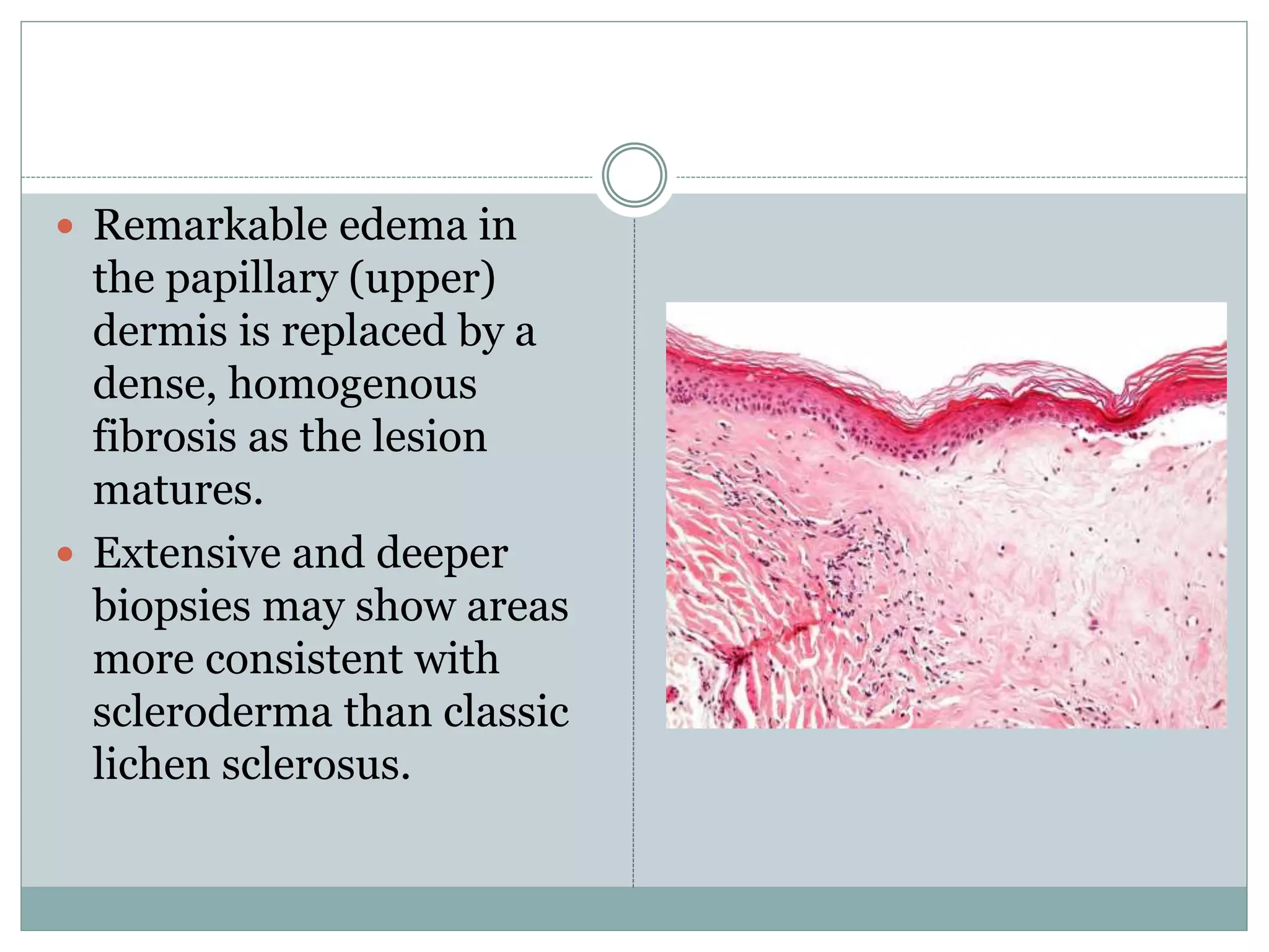 Lichen sclerosus by Saad Raheem Abed | PPTX