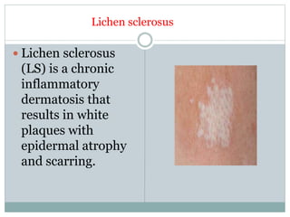 Lichen Sclerosus