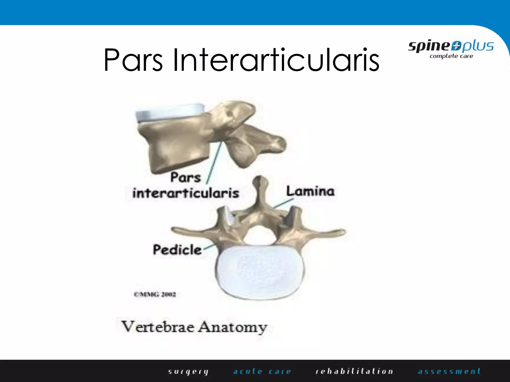 Pars defects and spondylolisthesis | PDF