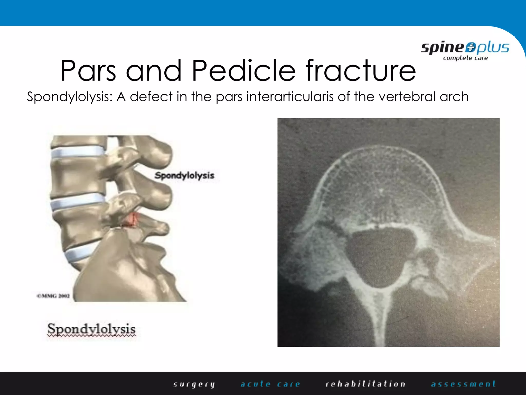 Pars defects and spondylolisthesis | PDF