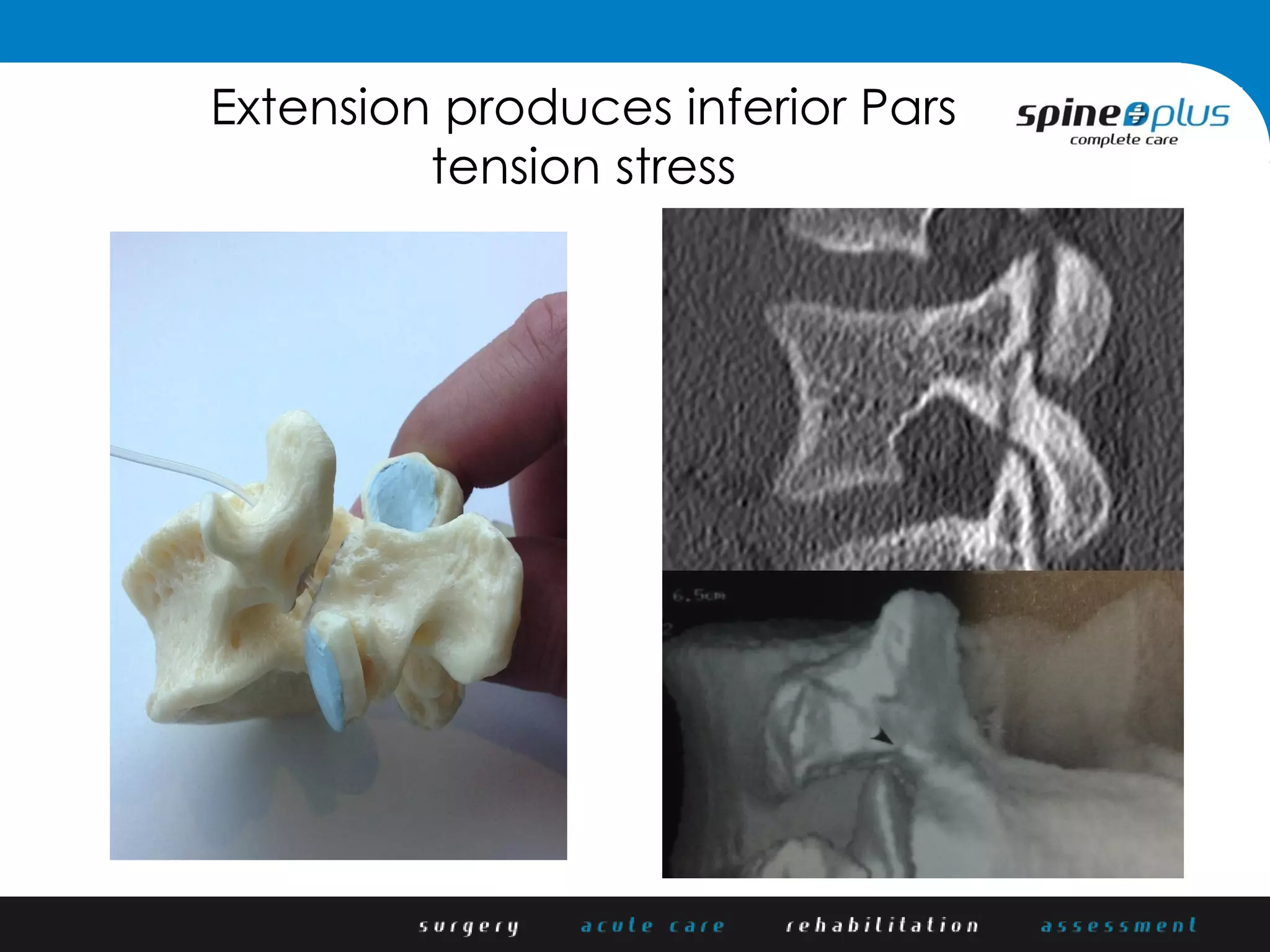 Pars defects and spondylolisthesis | PDF