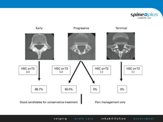 Pars defects and spondylolisthesis | PDF