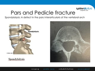 Pars defects and spondylolisthesis | PDF