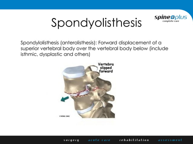 Pars defects and spondylolisthesis | PDF | Physical Therapy | Wellness