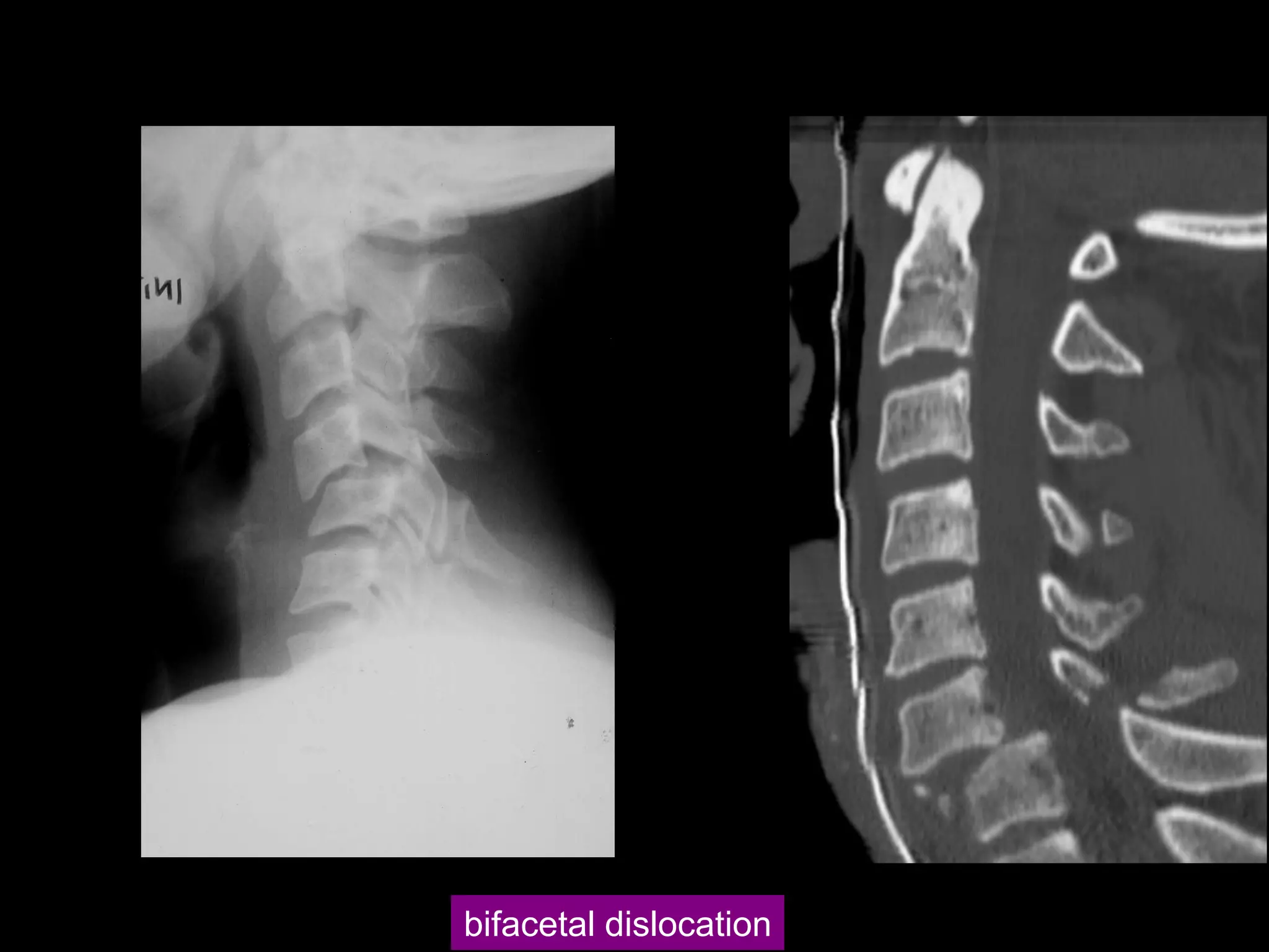 Facet dislocation management | PDF