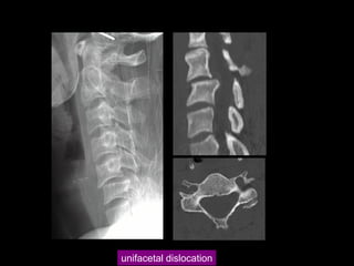 Facet dislocation management | PDF