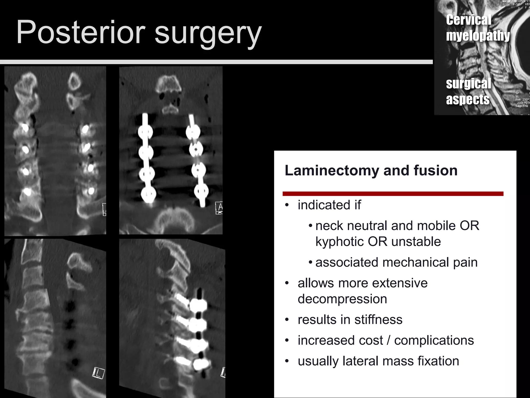 Myelopathy management | PDF