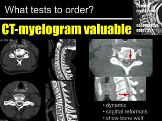 Myelopathy management | PDF