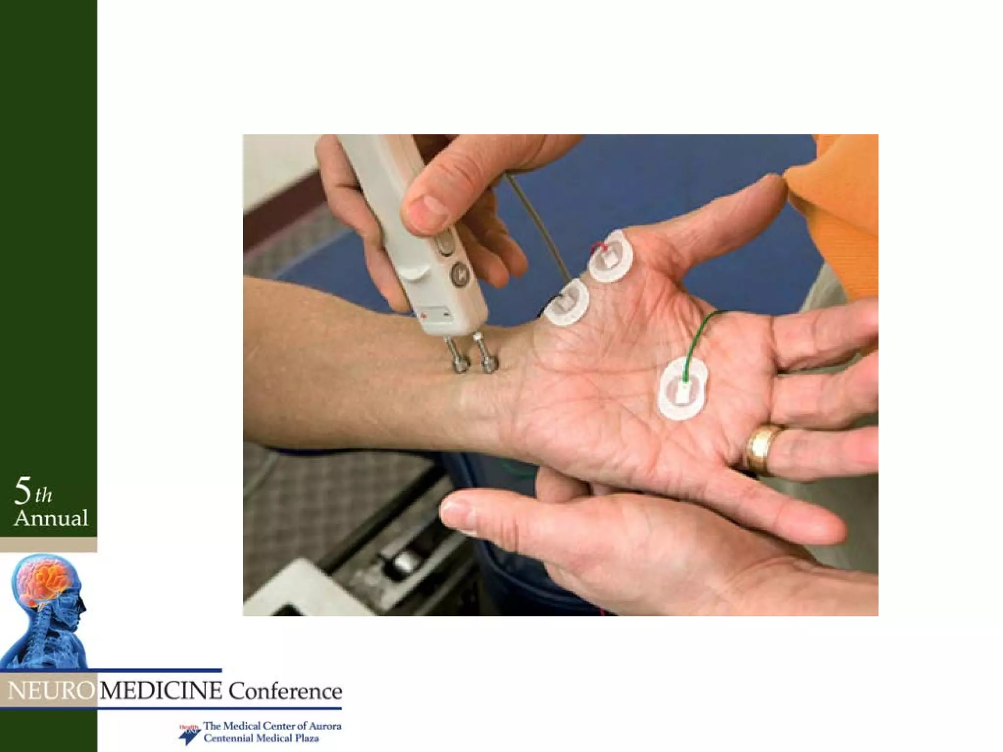 Radiculopathy Vs Peripheral Neuropathy Ppt