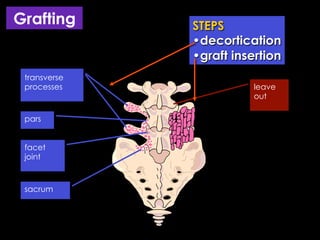 Surgery for low back pain | PDF