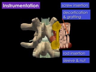 Surgery for low back pain | PDF