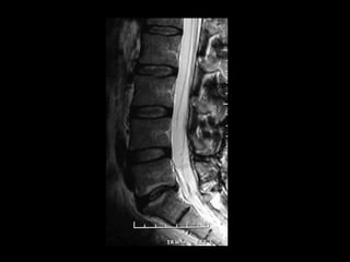 Surgery for low back pain | PDF