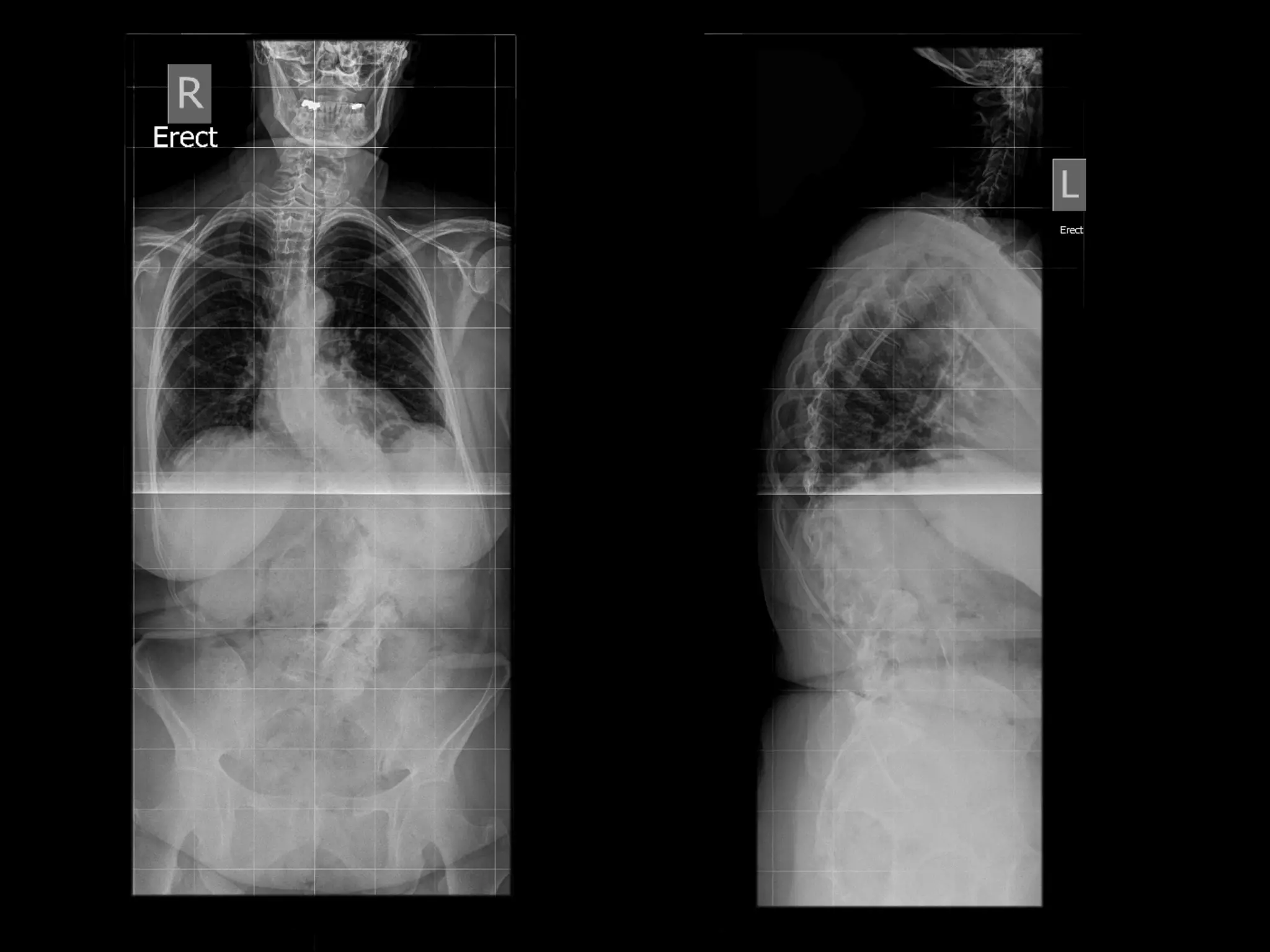 Surgery for low back pain | PPT