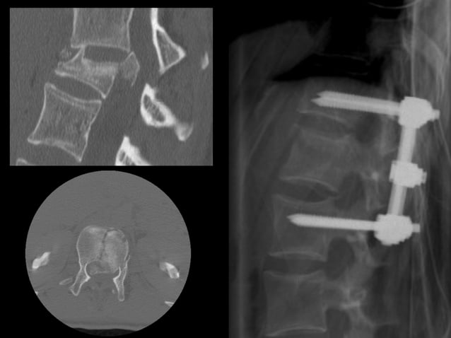 Surgery for low back pain | PPT