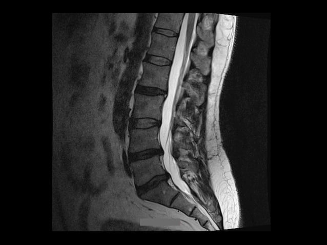 Surgery for low back pain | PPT