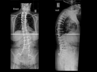 Surgery for low back pain | PPT