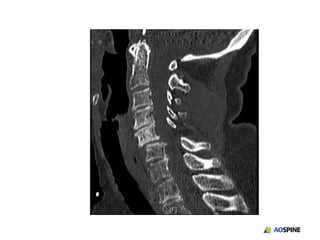 Unifacet dislocation MRI | PPT
